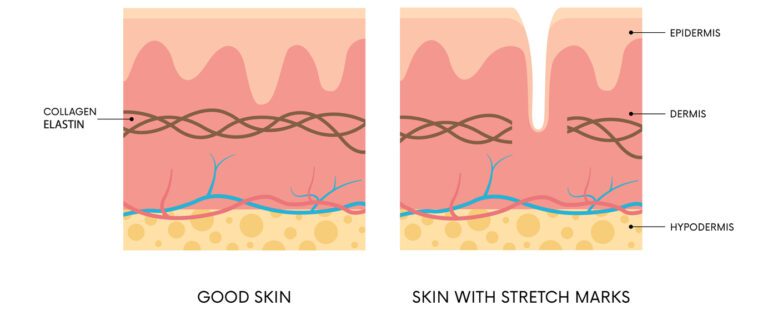 Stretch Mark Removal: Causes and Remedies